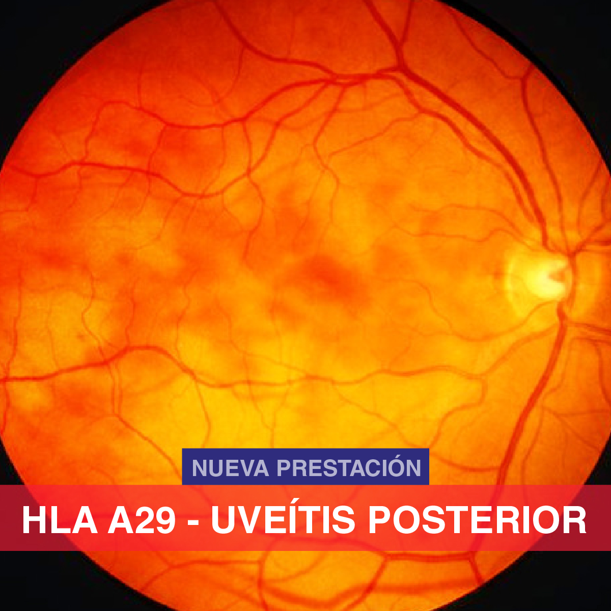 Nueva prestación: HLA A29 – Uveítis Posterior – MANLAB